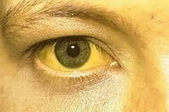 জন্ডিস হলে বোঝার উপায় ও করণীয়